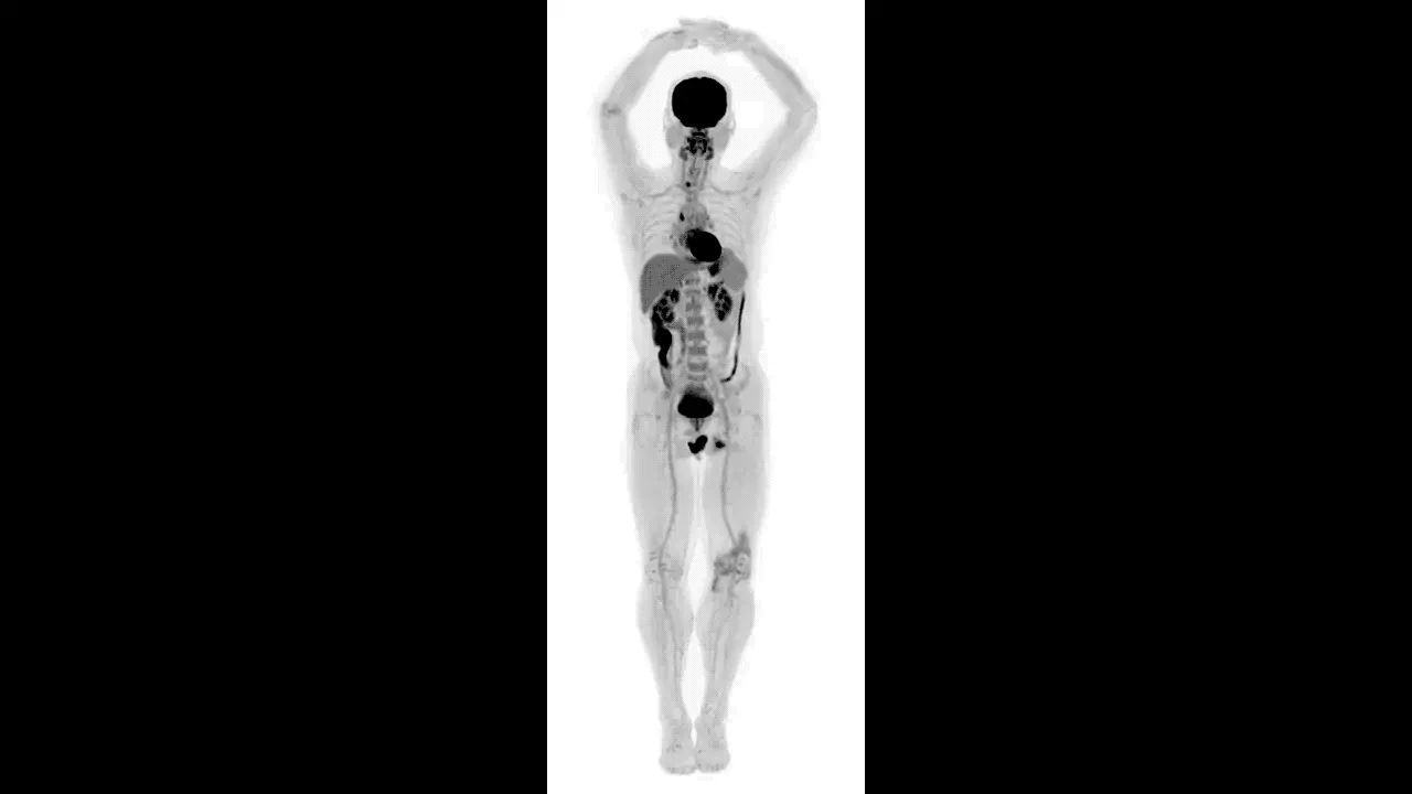 New 3D body scanner inoshandisa 40 times less radiation than PET scans 20864_1