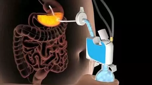 Sistem Penurunan Berat Badan yang Diluluskan FDA Menggalakkan Gangguan Pemakanan 24556_0