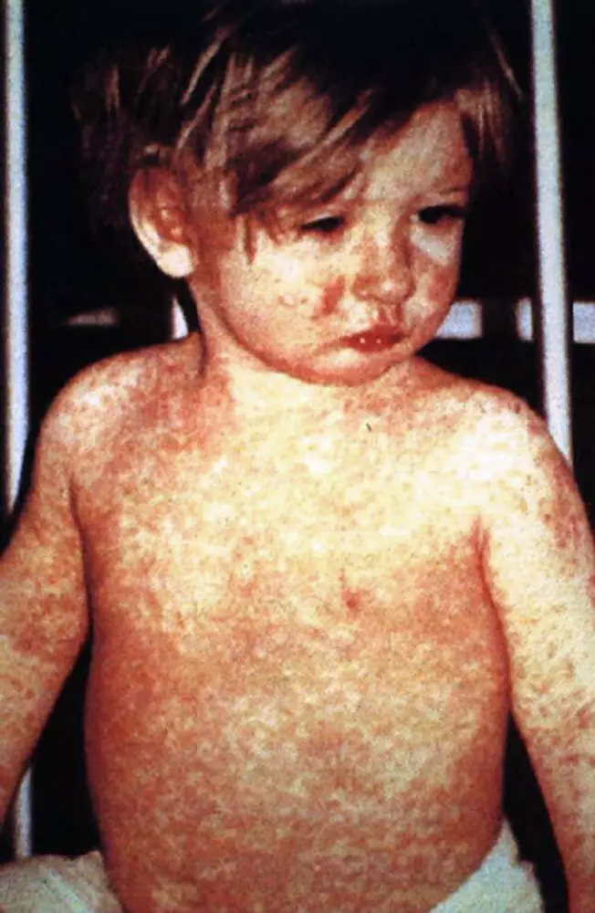 «Қайғылы және алдын алуға болады»: қызылша індеті Вашингтондағы вакцинаға қарсы «ыстық нүкте» арқылы таралады 29117_1