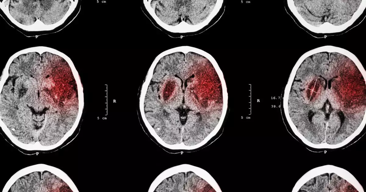 Веќе одобрен лек може да помогне во поправка на мозокот по мозочен удар