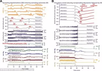 Le cerveau humain peut récupérer après une flatlining, selon une étude 48317_3