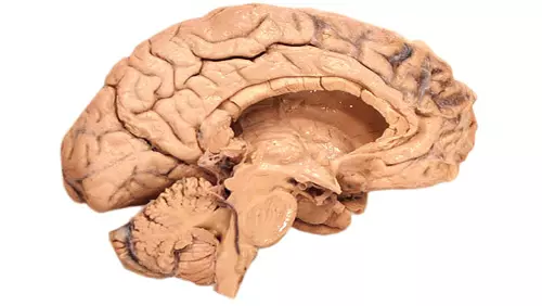 Amyloid Beta: kle nan debloke maladi alzayme a? 55653_0