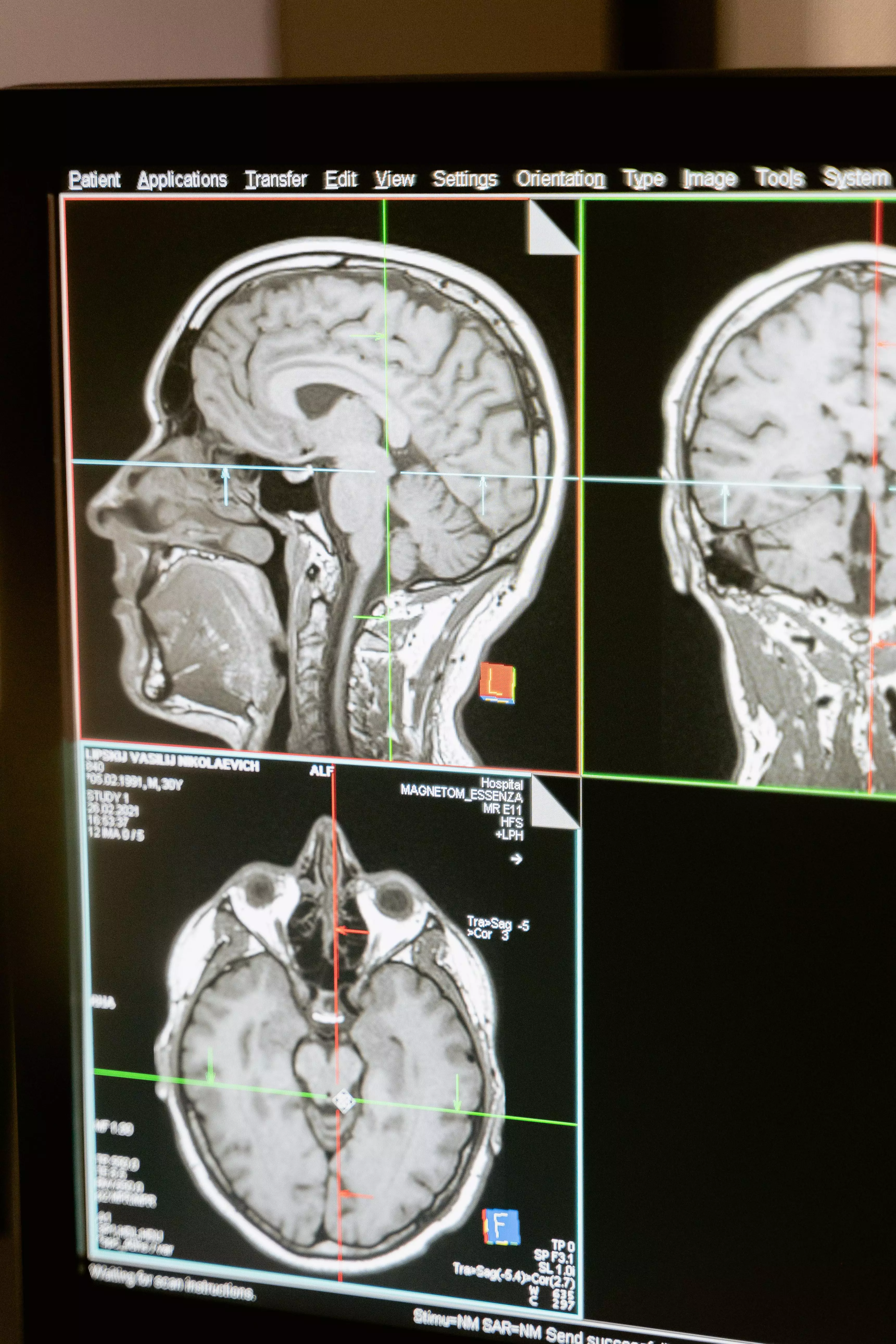 Studimi: Ekzistojnë katër lloje të sëmundjes së Alzheimerit 5656_1