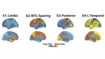 Çalışma: Dört tip Alzheimer hastalığı vardır 5656_2