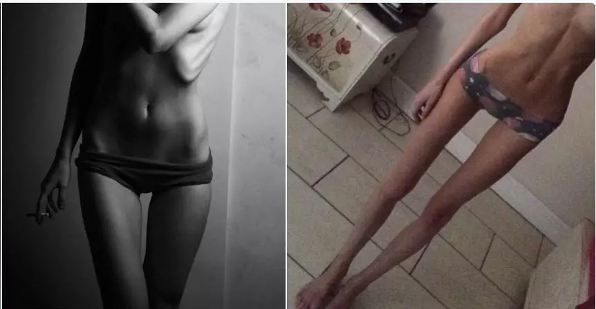Anorektičky předvádějí svá „thinspirativní“ těla na sociálních sítích 57121_0