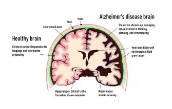 35 porsyento lamang sa mga Amerikano ang nahibal-an ang mga sintomas sa sakit nga Alzheimer 8448_2